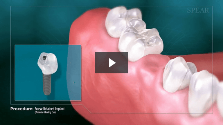 Screw-Retained Implant (Posterior- Healing Cap) - Cosmetic Dentistry